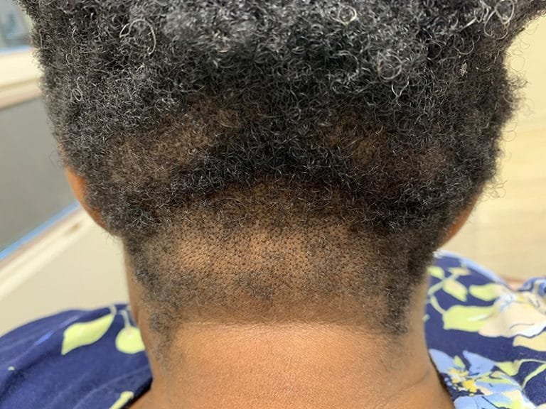 Hair Restoration Before and After Photos | Dr. Steven Davis
