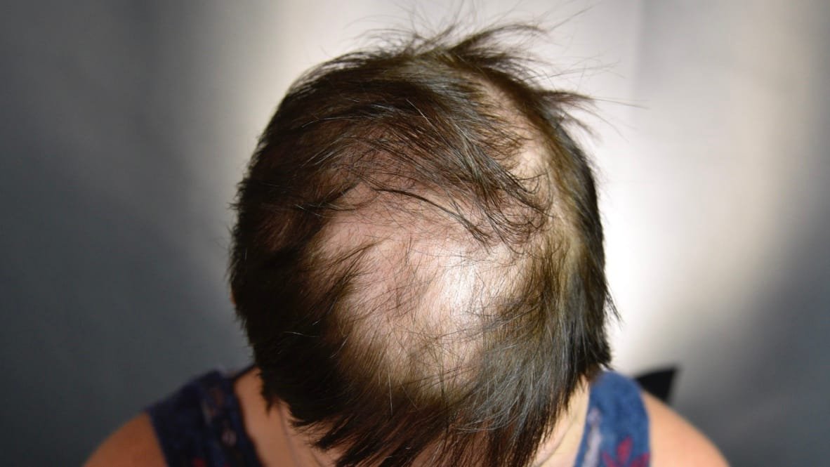 Hair Restoration for Women: Addressing Unique Challenges - Davis Hair ...